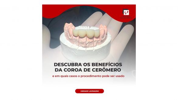 Você já ouviu falar em coroa dental de cerômero? – Lavras24horas